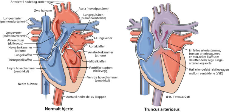 Truncus arteriosus